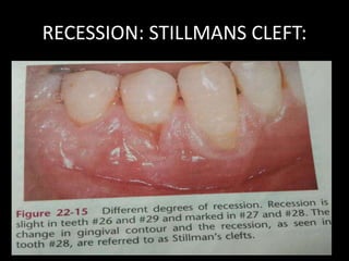 Clinical reatures of gingivitis | PPT