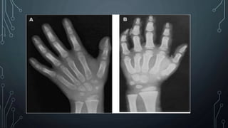 Clinical relevance of chronologic, dental, and skeletal age | PPTX