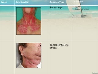 Clinical response of skin and mucosa to radiation | PPTX