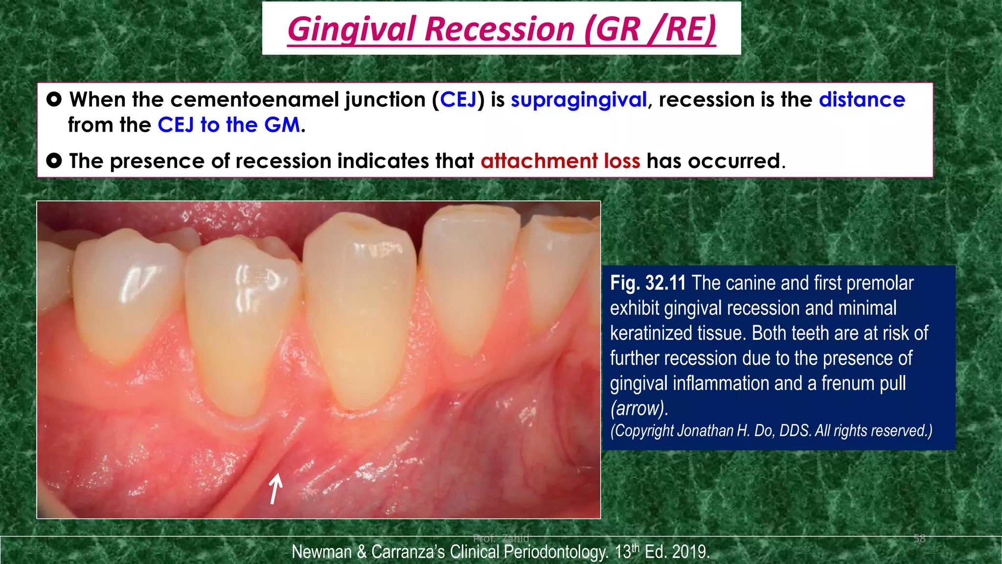 Clinical risk assessment & diagnosis of periodontal disease | PDF