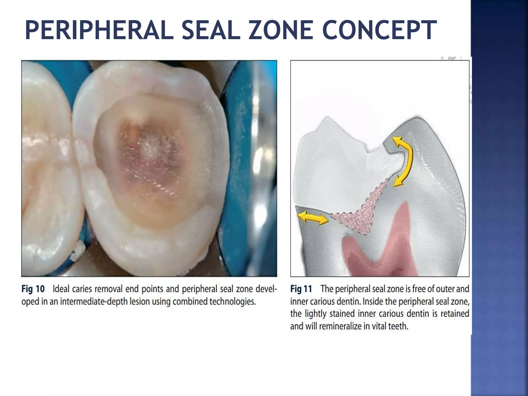 CLINICAL SIGNIFICANCE OF DENTIN.pptx