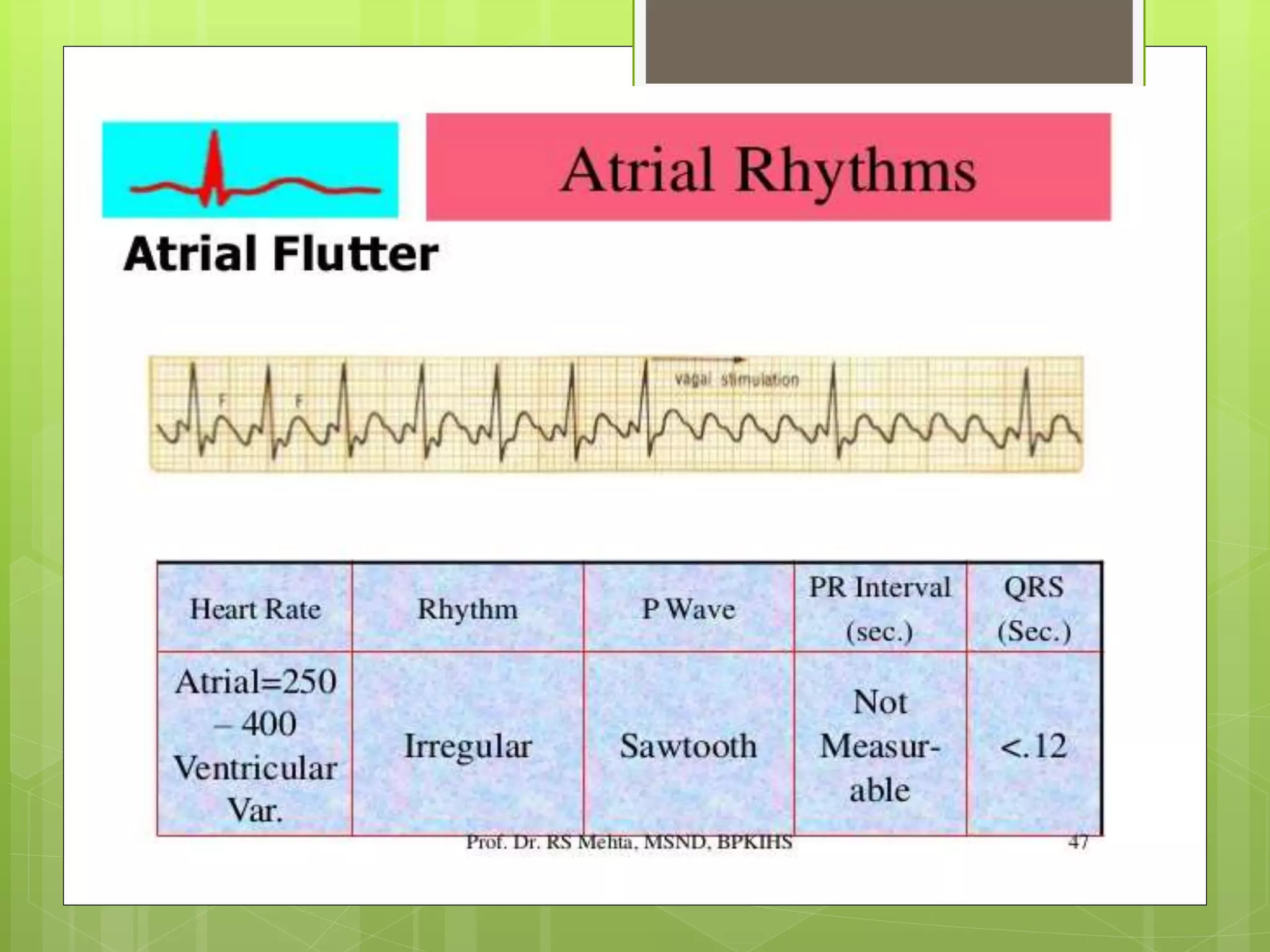 Clinical signs of arrythmia | PPT