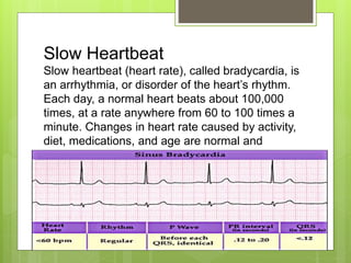 Clinical signs of arrythmia | PPT