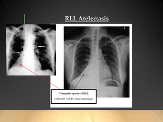 CXR and abdominal film interpretation for medical student | PDF