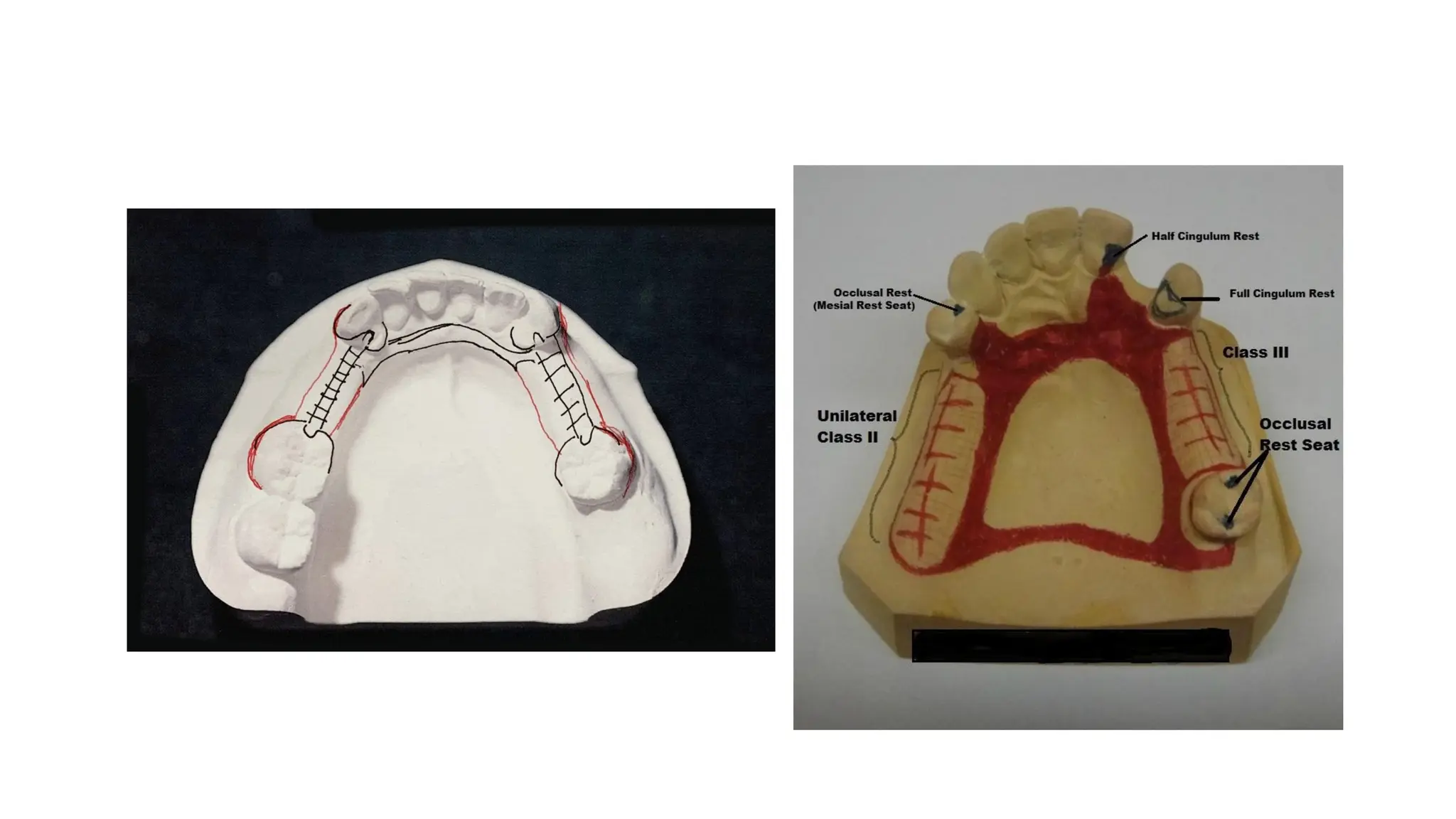 CLINICAL STAGES OF FABRICATION of Removable partial dentures | PPTX