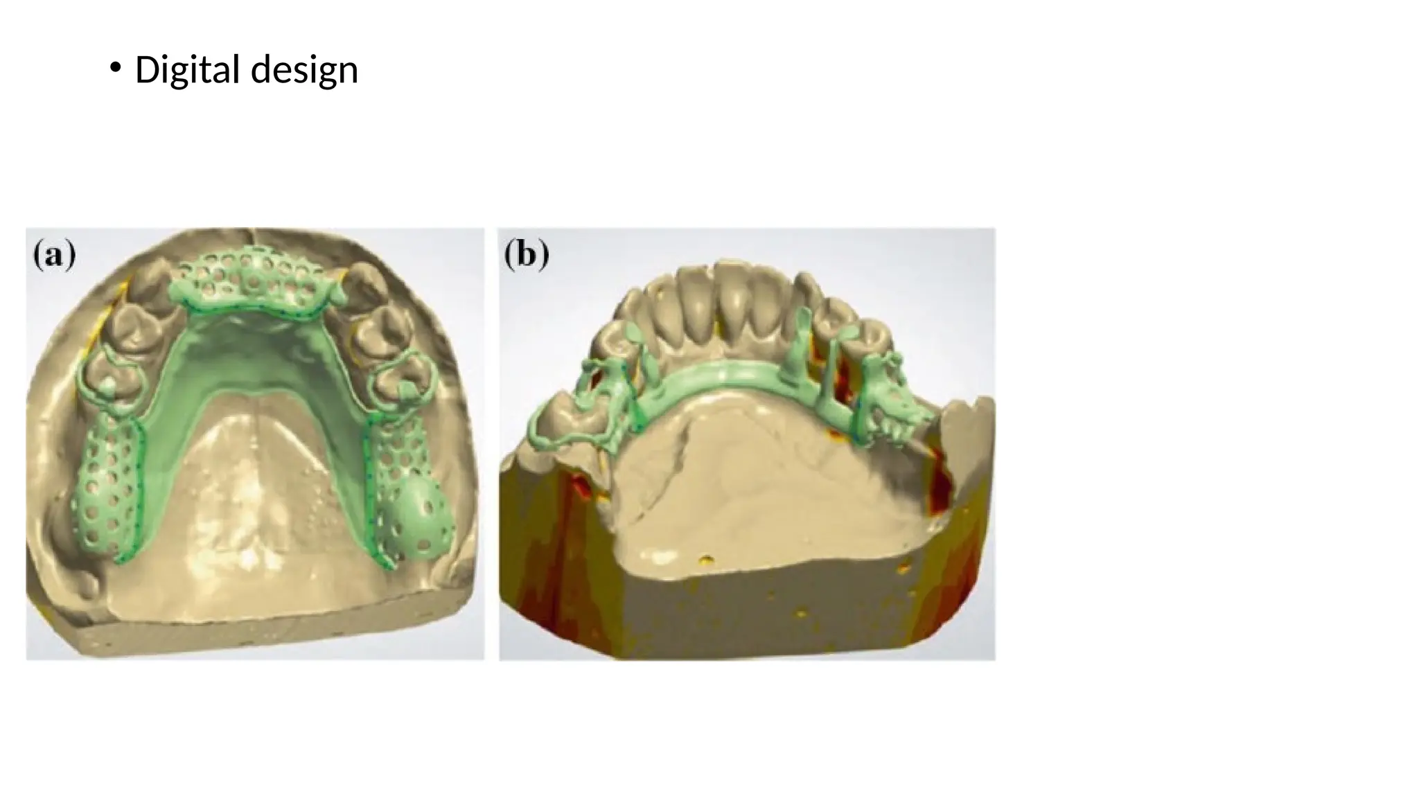 CLINICAL STAGES OF FABRICATION of Removable partial dentures | PPTX