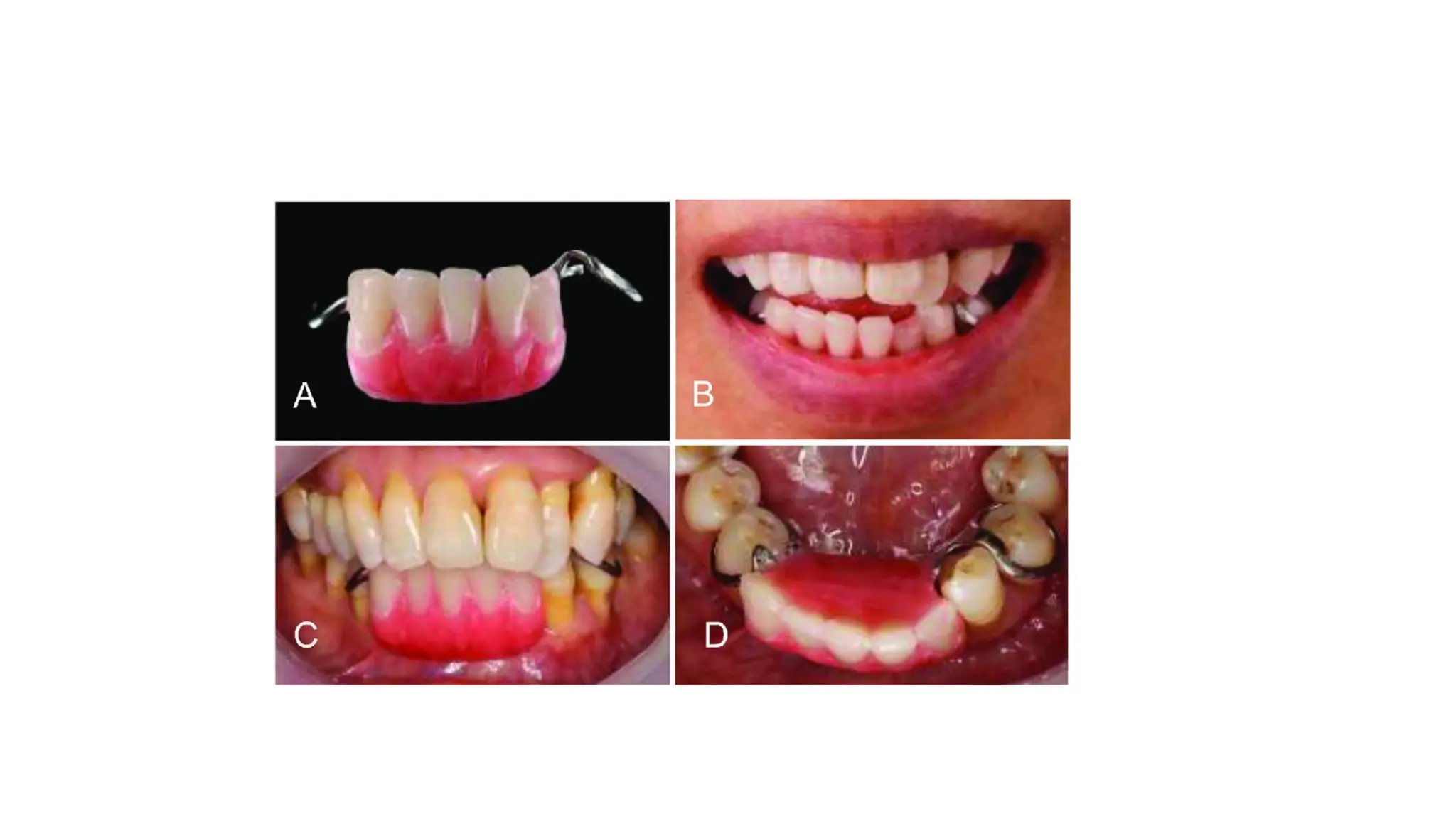 CLINICAL STAGES OF FABRICATION of Removable partial dentures | PPTX