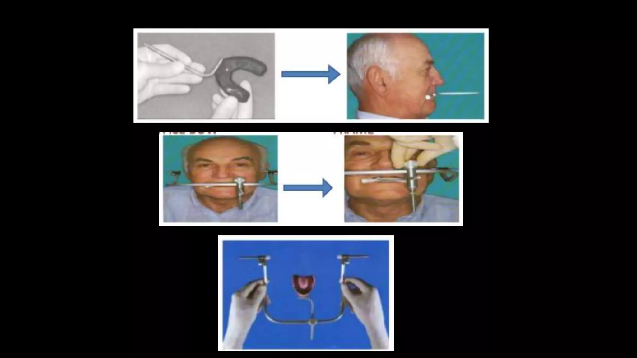 Clinical steps in fabricating a complete denture | PPTX