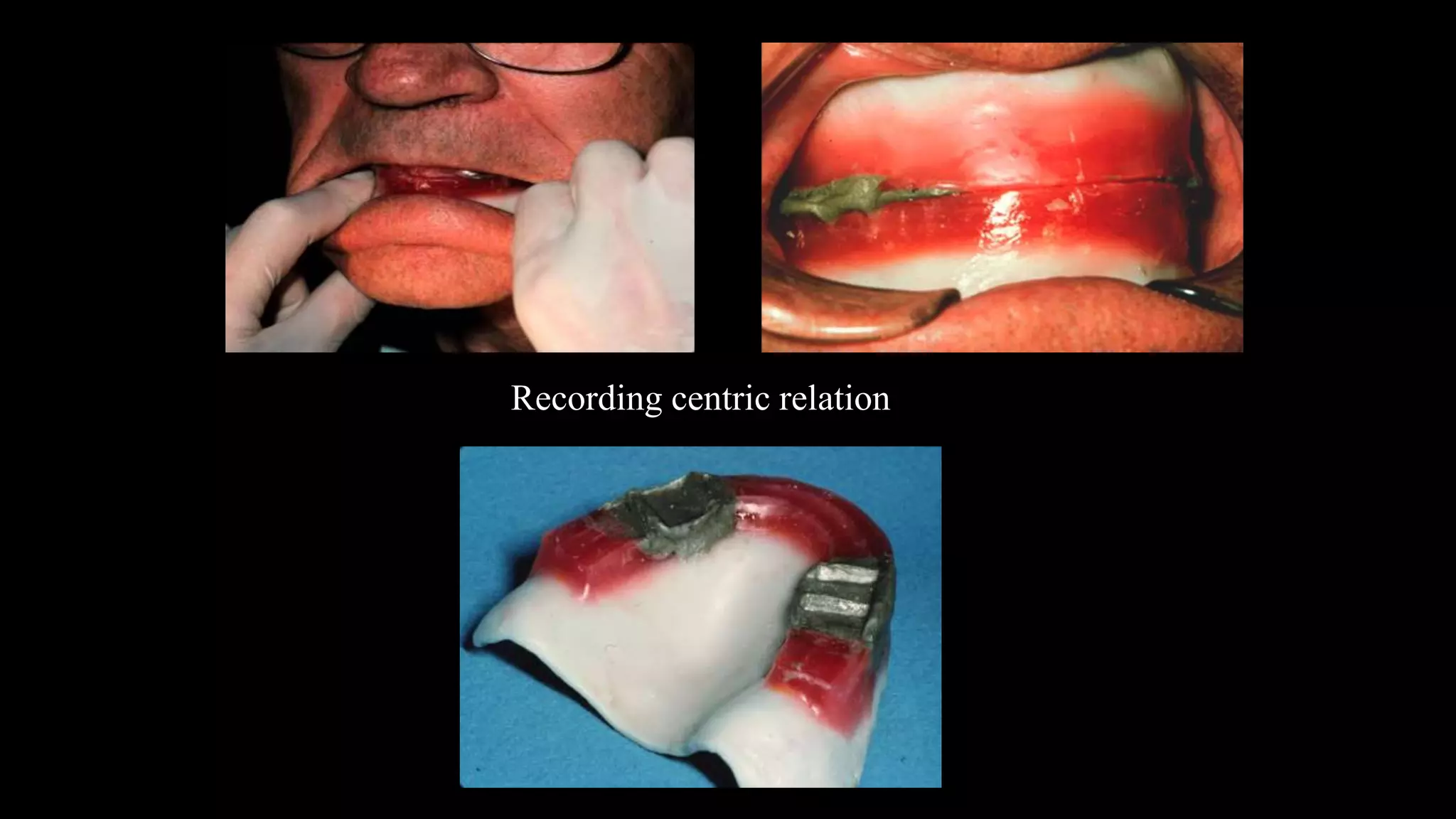 Clinical steps in fabricating a complete denture | PPTX