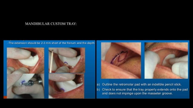 Clinical steps in fabricating a complete denture | PPTX