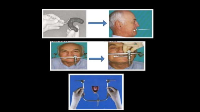 Clinical steps in fabricating a complete denture | PPTX