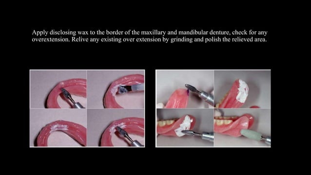 Clinical steps in fabricating a complete denture | PPTX