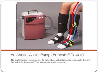 Preventing Amputation with an Arterial Compression Pump | PPT