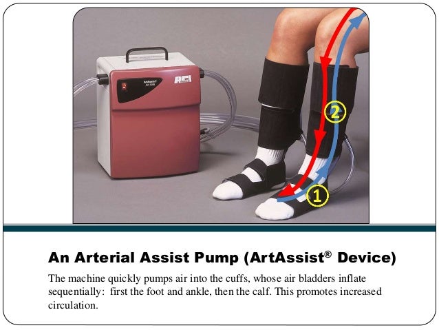 Preventing Amputation with an Arterial Compression Pump