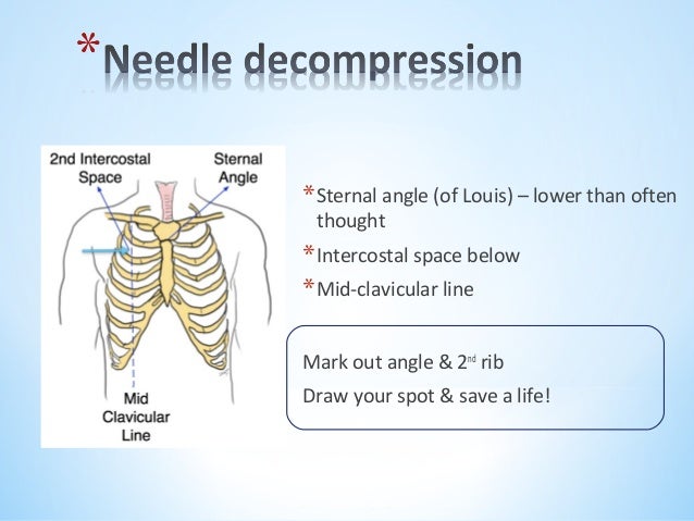 Where Is The 2nd Intercostal Space