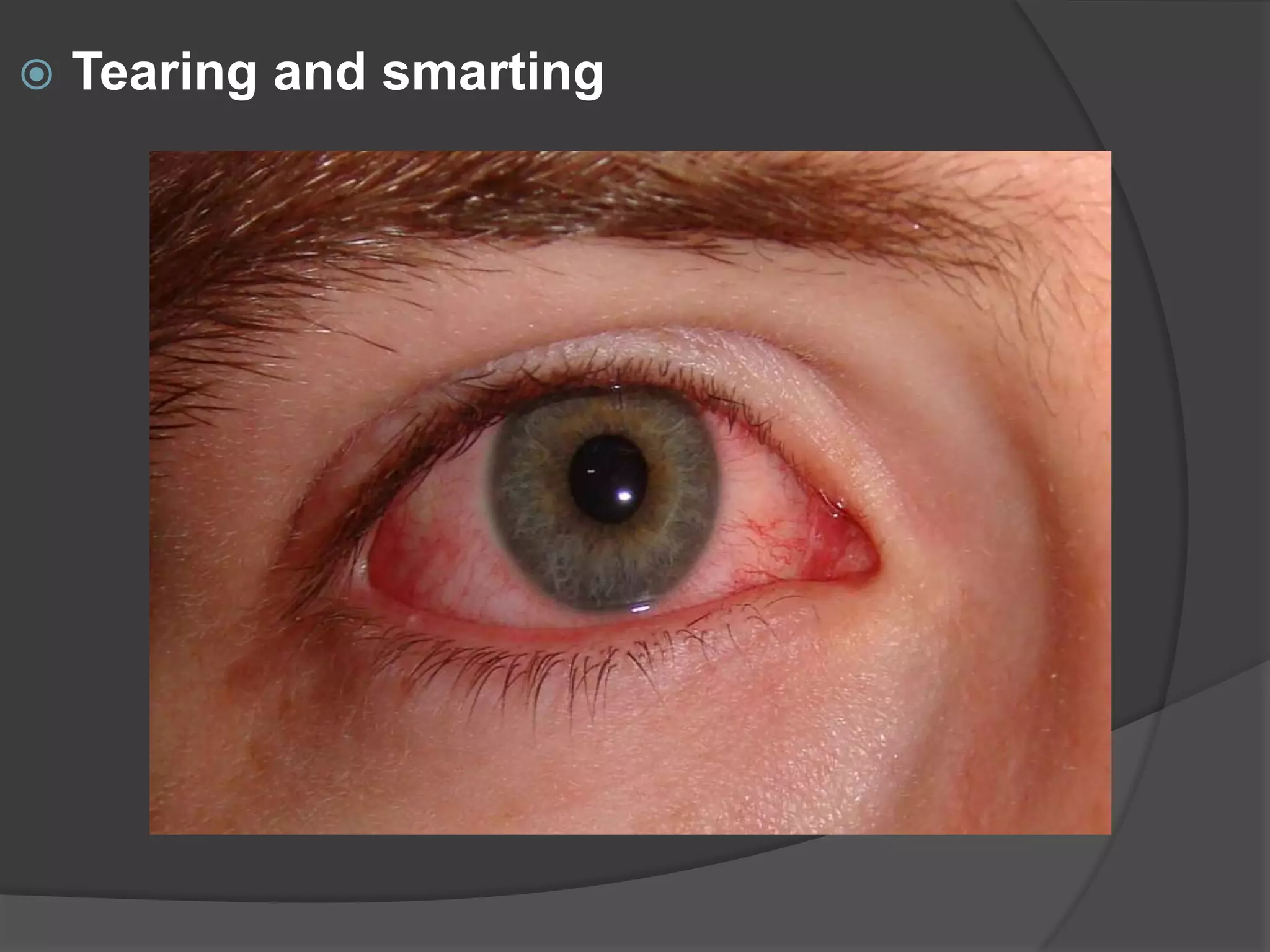 Clinical symptoms of astigmatism | PPTX