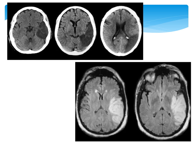 Clinical Syndromes of Cerebral Ischemic Stroke pp.pptx