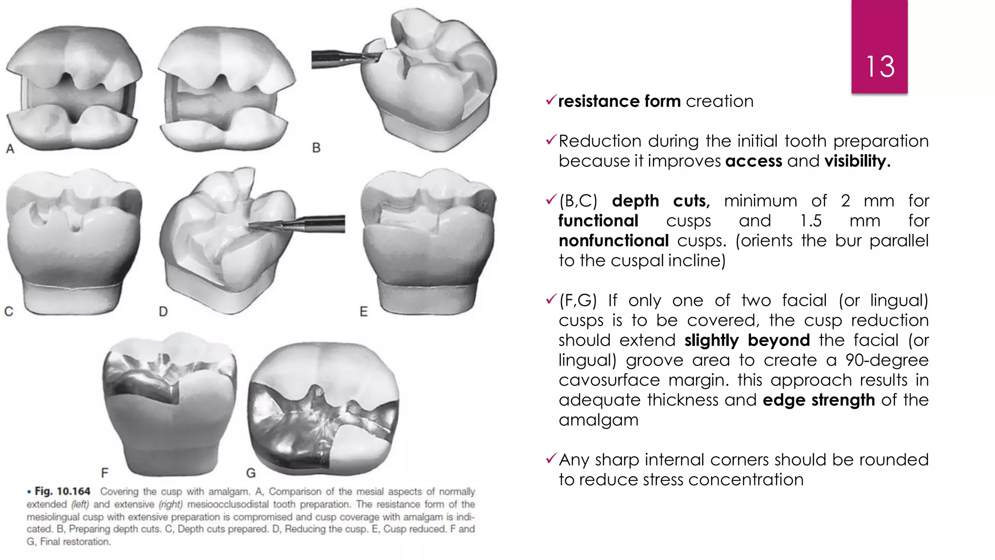 Clinical technique for complex Amalgam Restoration | PDF