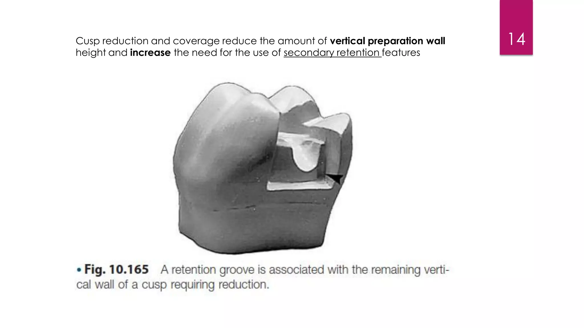 Clinical technique for complex Amalgam Restoration | PDF