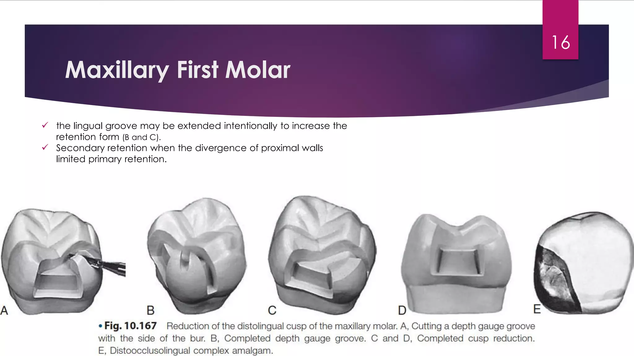 Clinical technique for complex Amalgam Restoration | PDF