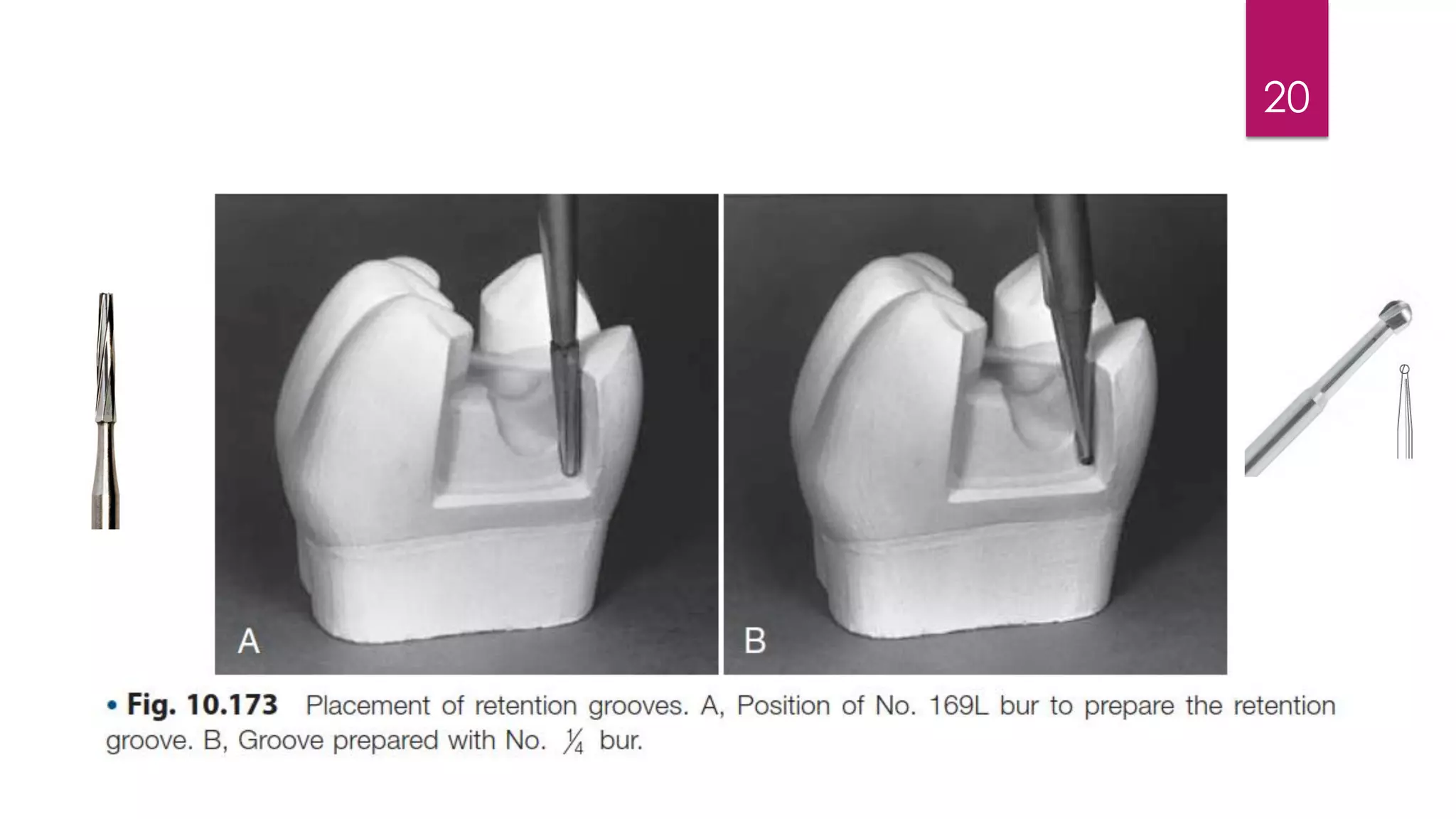 Clinical technique for complex Amalgam Restoration | PDF