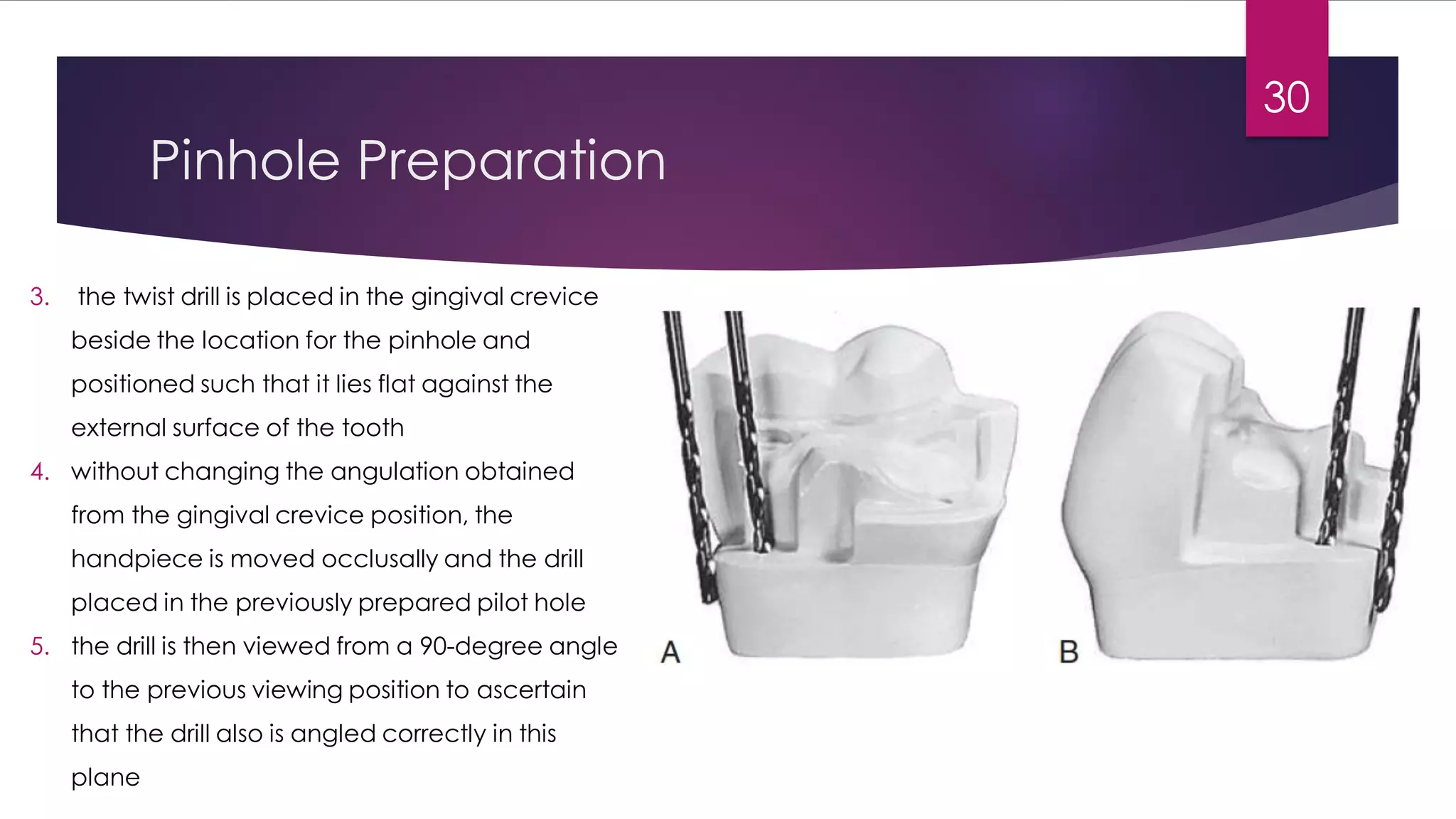 Clinical technique for complex Amalgam Restoration | PDF