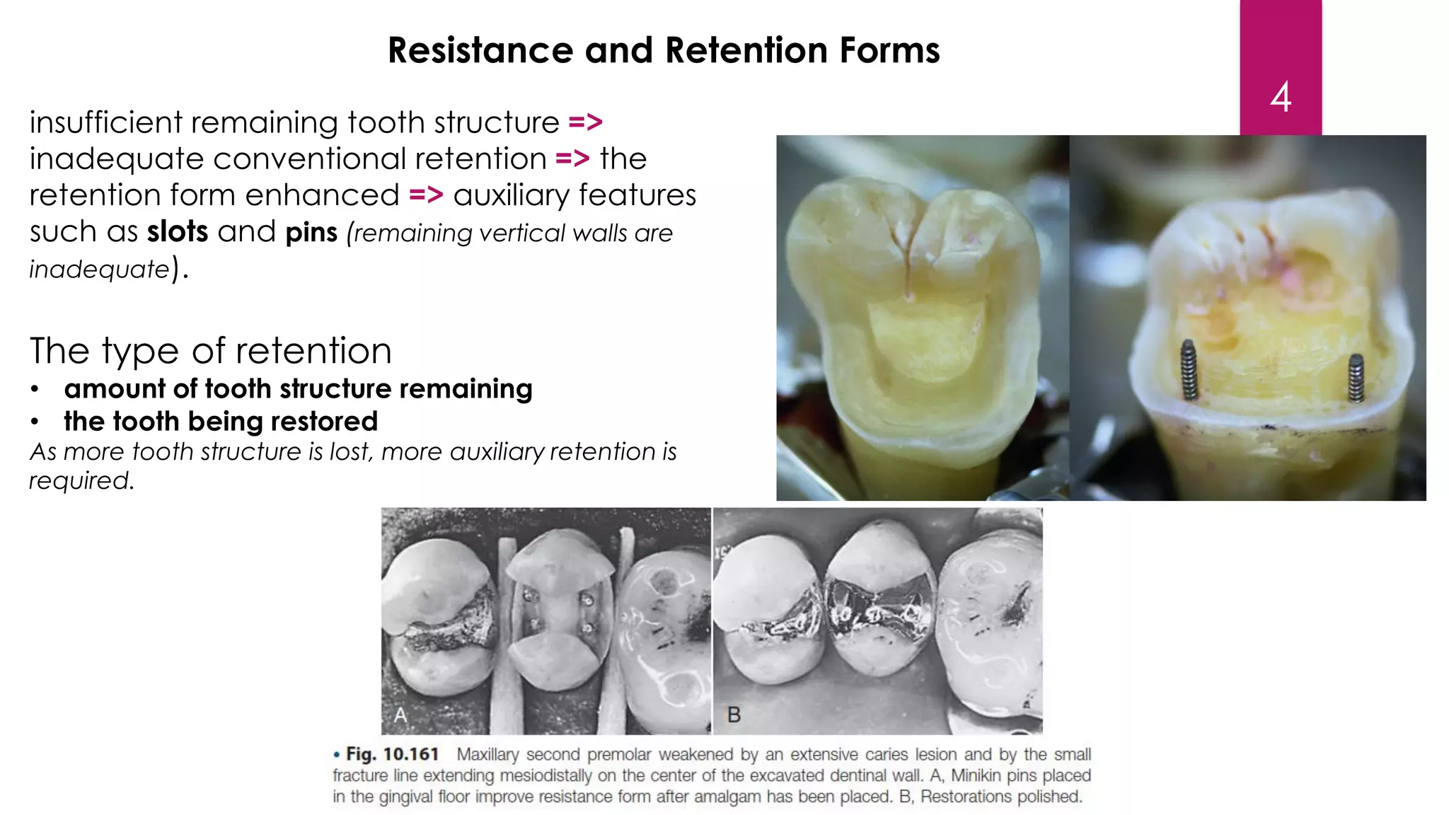 Clinical technique for complex Amalgam Restoration | PDF