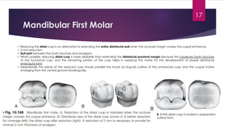 Clinical technique for complex Amalgam Restoration | PDF