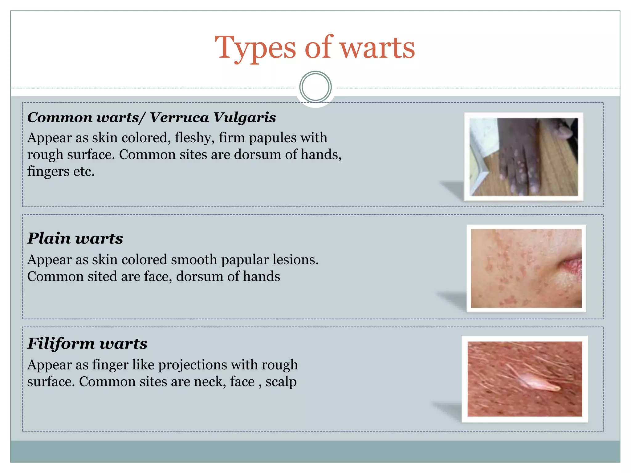 Clinical tips for the homoepathic treatment of warts | PPTX