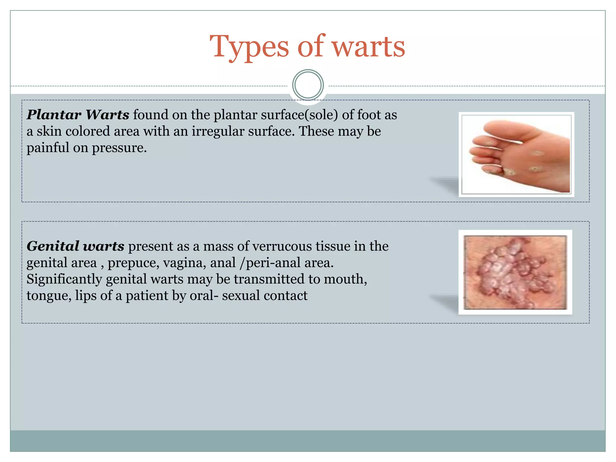 Clinical tips for the homoepathic treatment of warts | PPTX