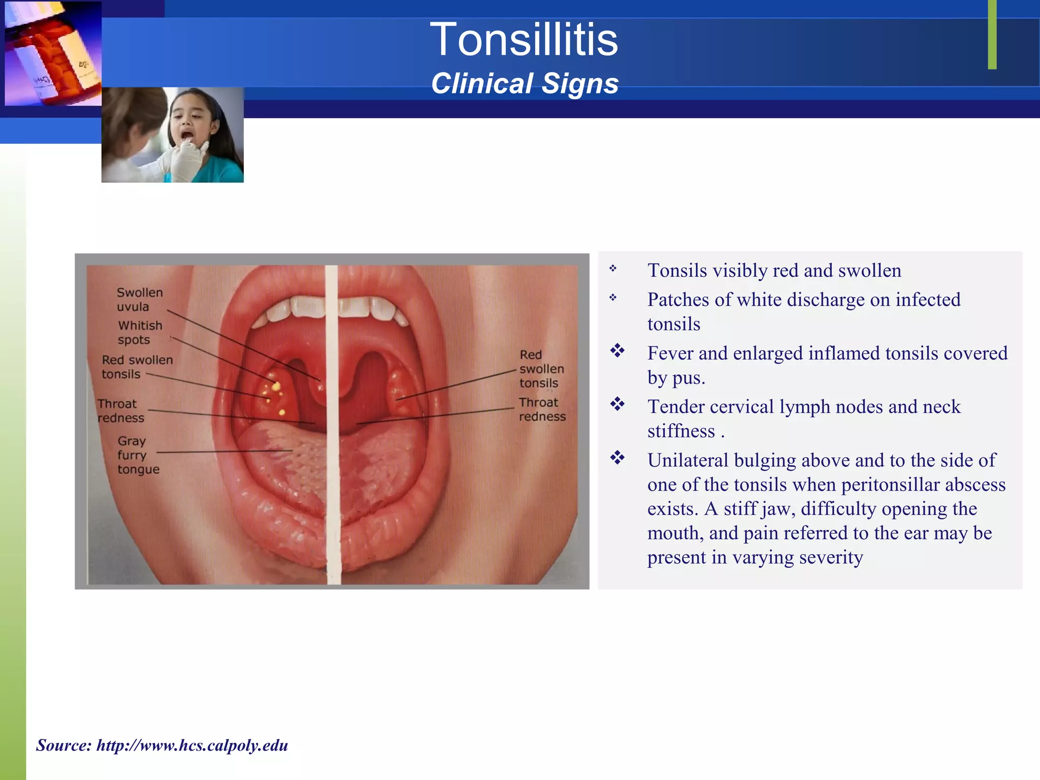 Clinical tips for the management of adeno tonsillitis | PPT