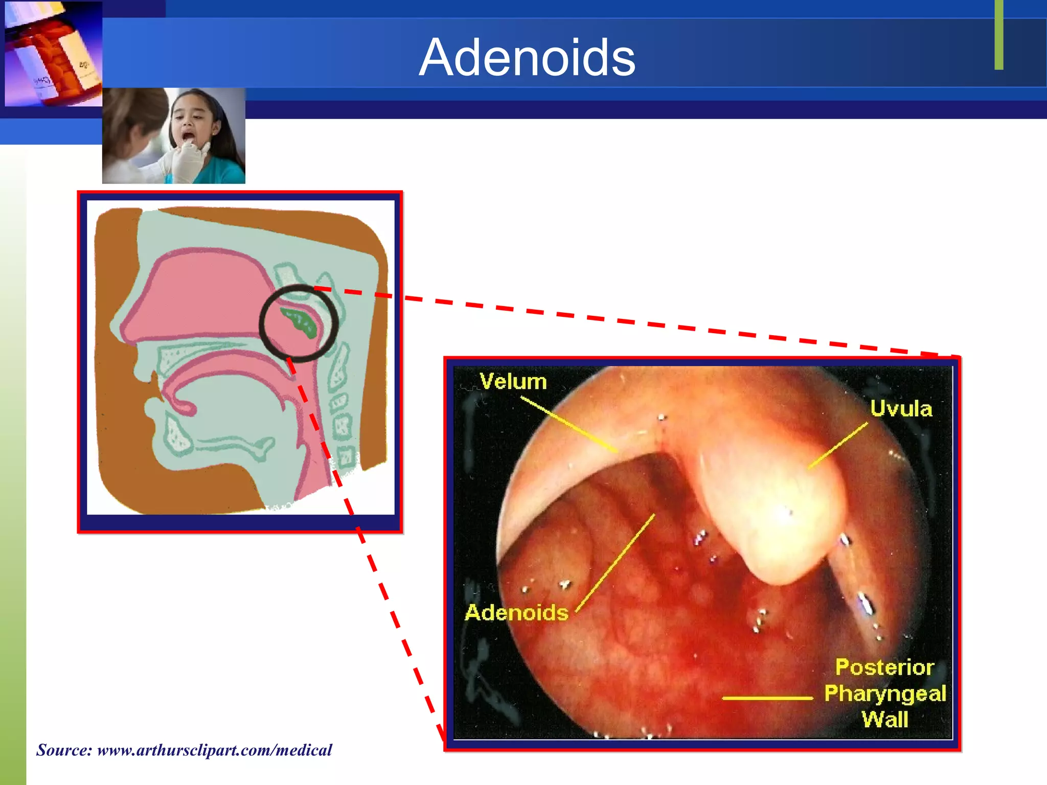 Clinical tips for the management of adeno tonsillitis | PPT