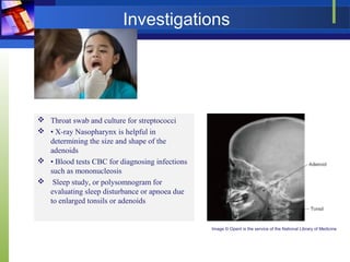 Clinical tips for the management of adeno tonsillitis | PPT