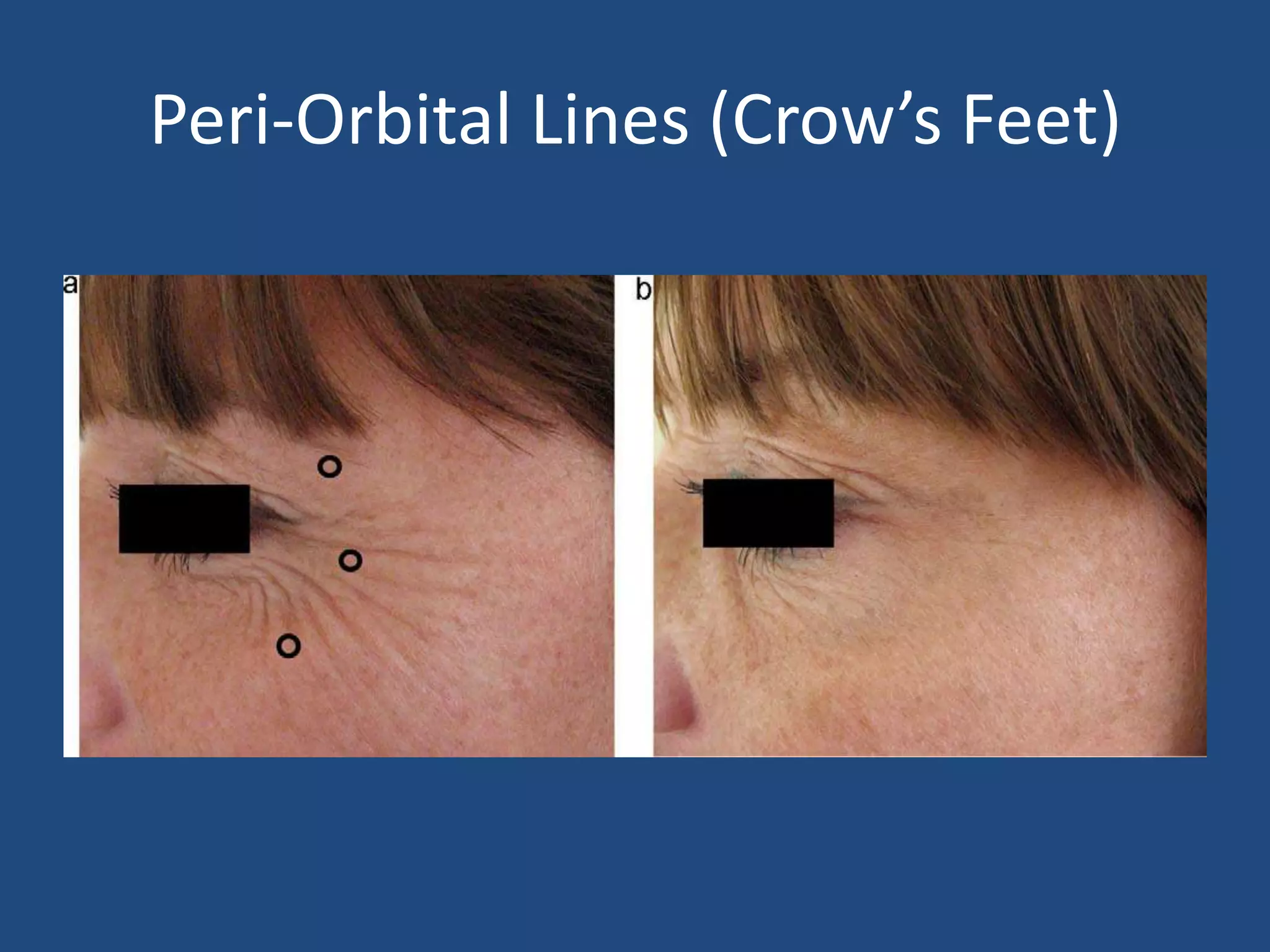 Clinical use of botulinum toxins in omfs | PPTX