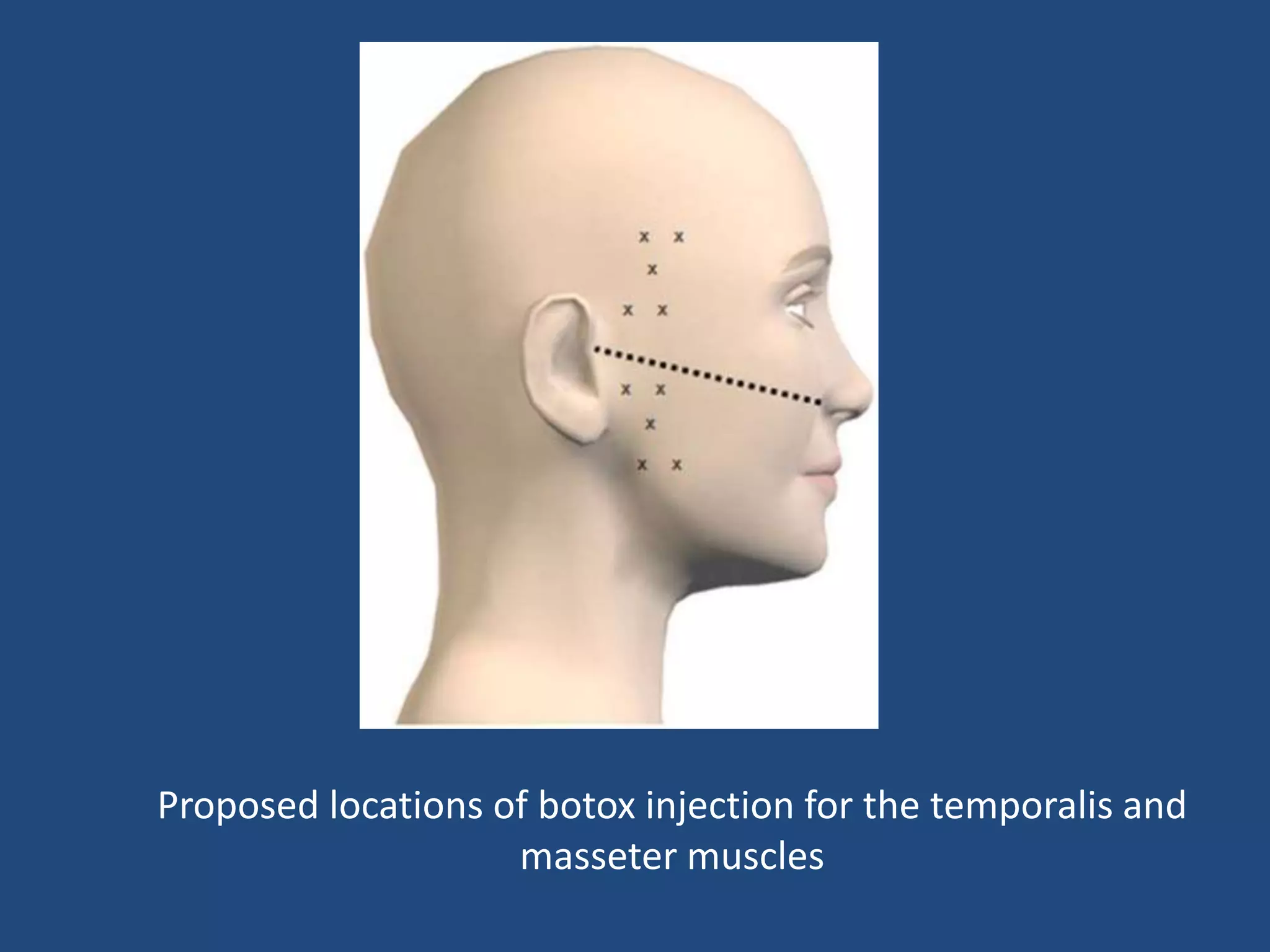 Clinical use of botulinum toxins in omfs | PPTX