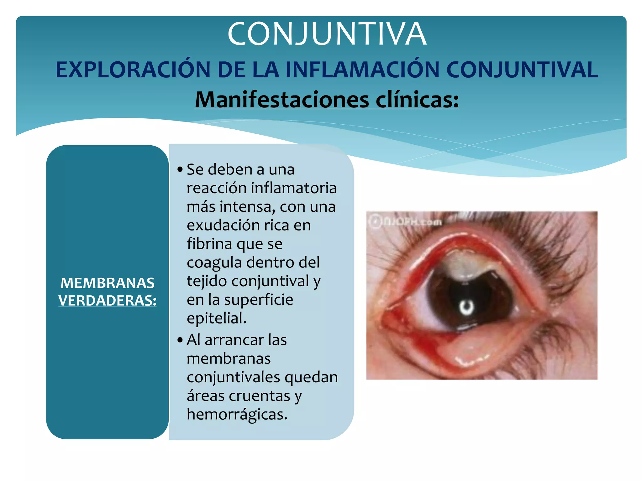 Clínica oftalmológica pregrado tema Conjuntiva | PPT