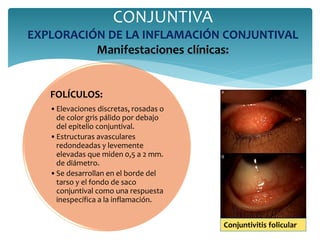 Clínica oftalmológica pregrado tema Conjuntiva | PDF