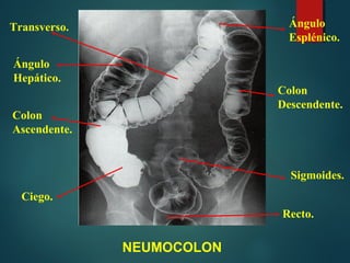 Tumor en RX de colon x enema Diagnóstico Imagenológico Clínico ...