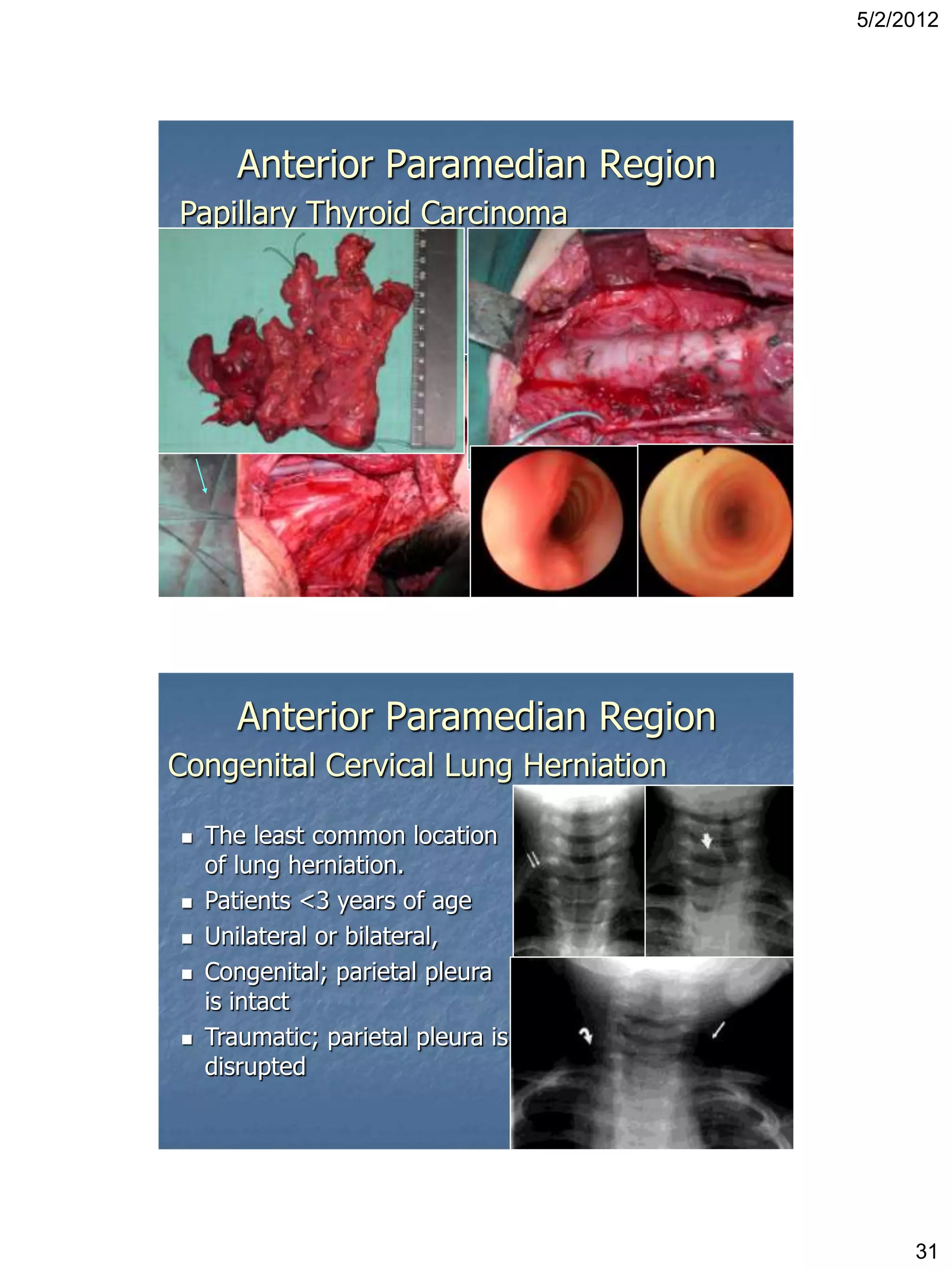 Clinico radiological approach for diagnosis of neck swellings | PDF ...
