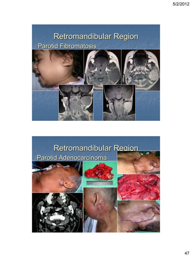 Clinico Radiological Approach For Diagnosis Of Neck Swellings Pdf