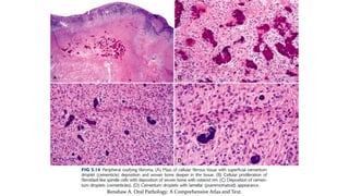 Peripheral Ossifying Fibroma Histology