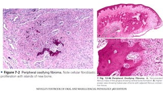 Peripheral Ossifying Fibroma Histology