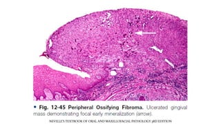 Peripheral Ossifying Fibroma Histology
