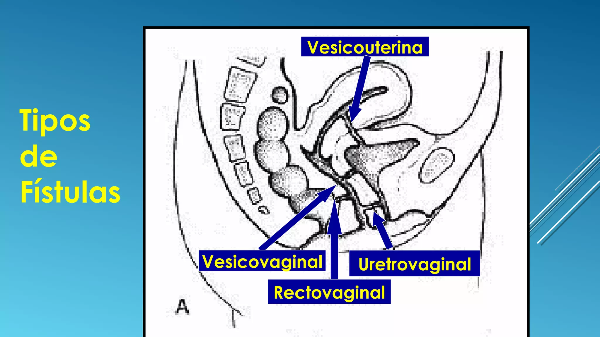 Fístula colo-vesical. Imagenología Clinico radiológica. | PPT