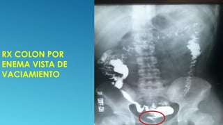 Fístula colo-vesical. Imagenología Clinico radiológica. | PPT