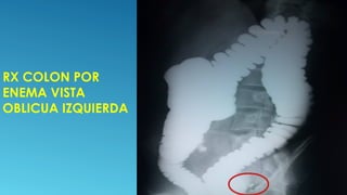 Fístula colo-vesical. Imagenología Clinico radiológica. | PPT