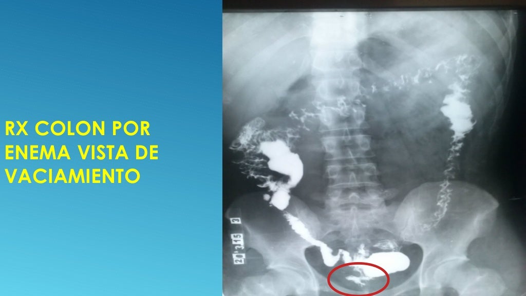 Fístula colo-vesical. Imagenología Clinico radiológica.