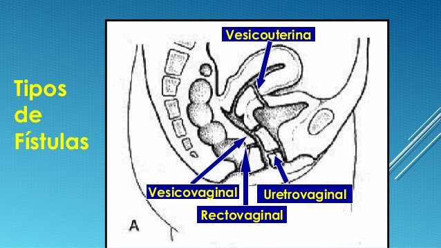 Fístula colo-vesical. Imagenología Clinico radiológica.