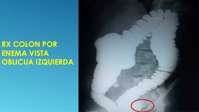 Fístula colo-vesical. Imagenología Clinico radiológica.