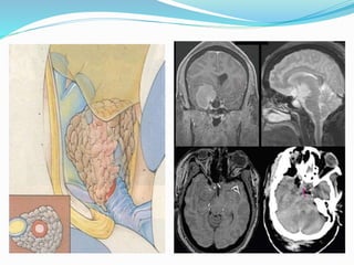 Clinoidal meningioma | PPTX